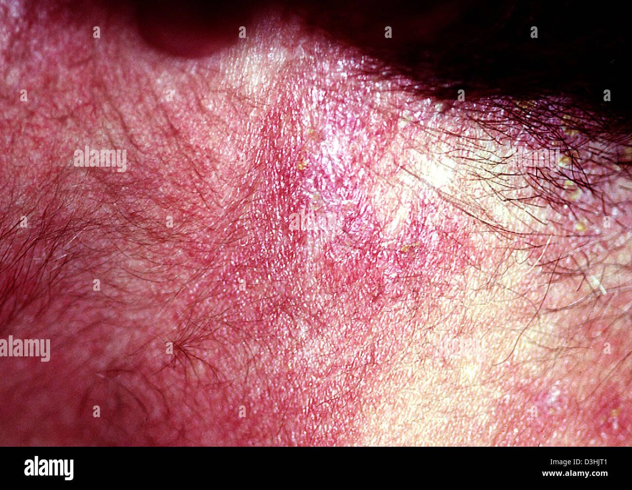 Disease Dropsy High Resolution Stock Photography and Images - Alamy