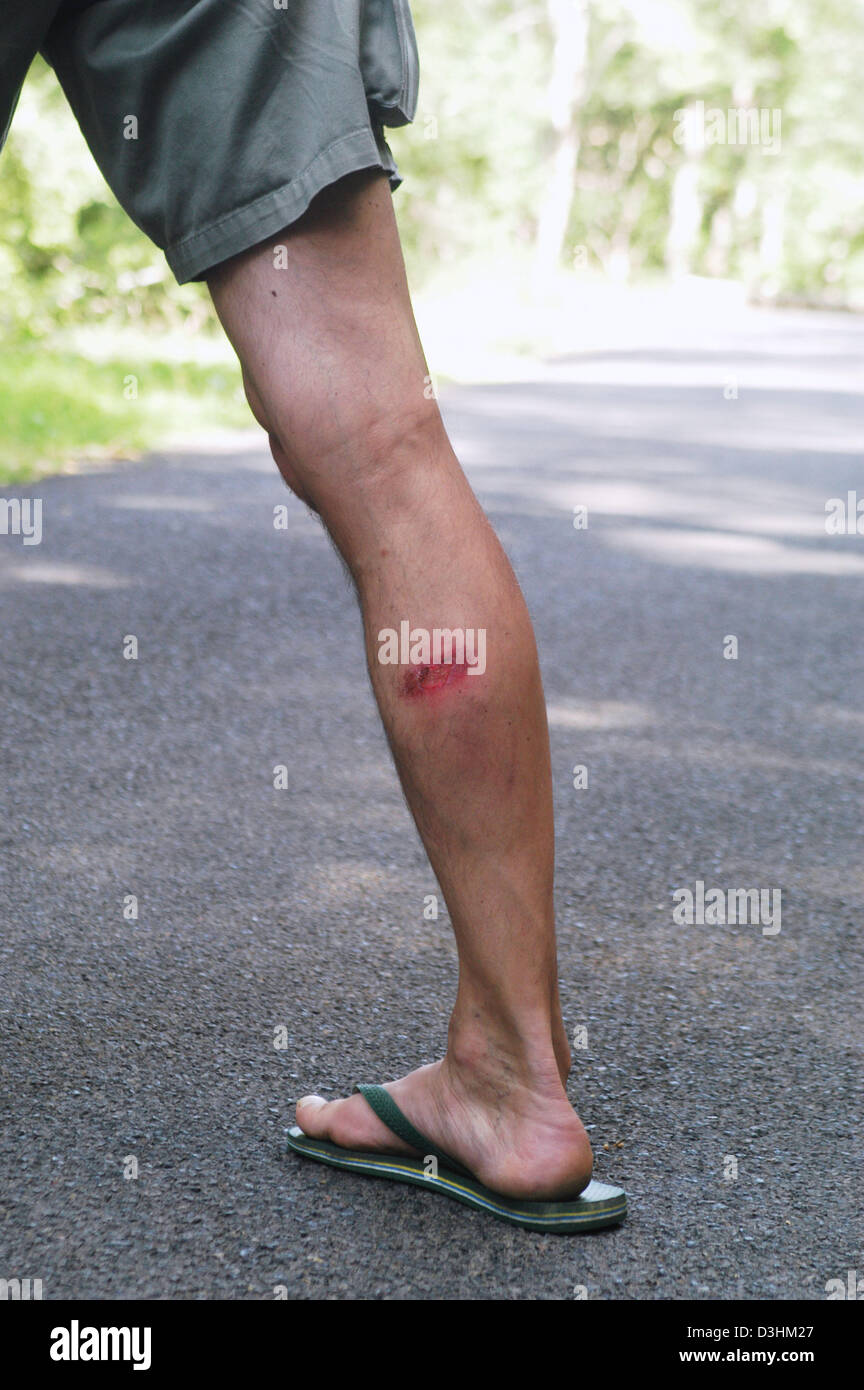 Skin burns wounds hi-res stock photography and images - Alamy