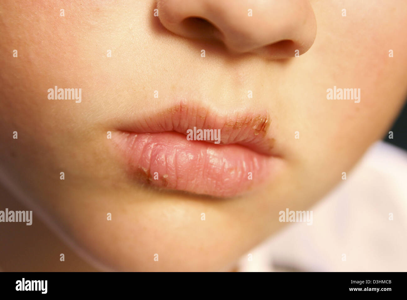 Children chapped lips hi-res stock photography and images - Alamy