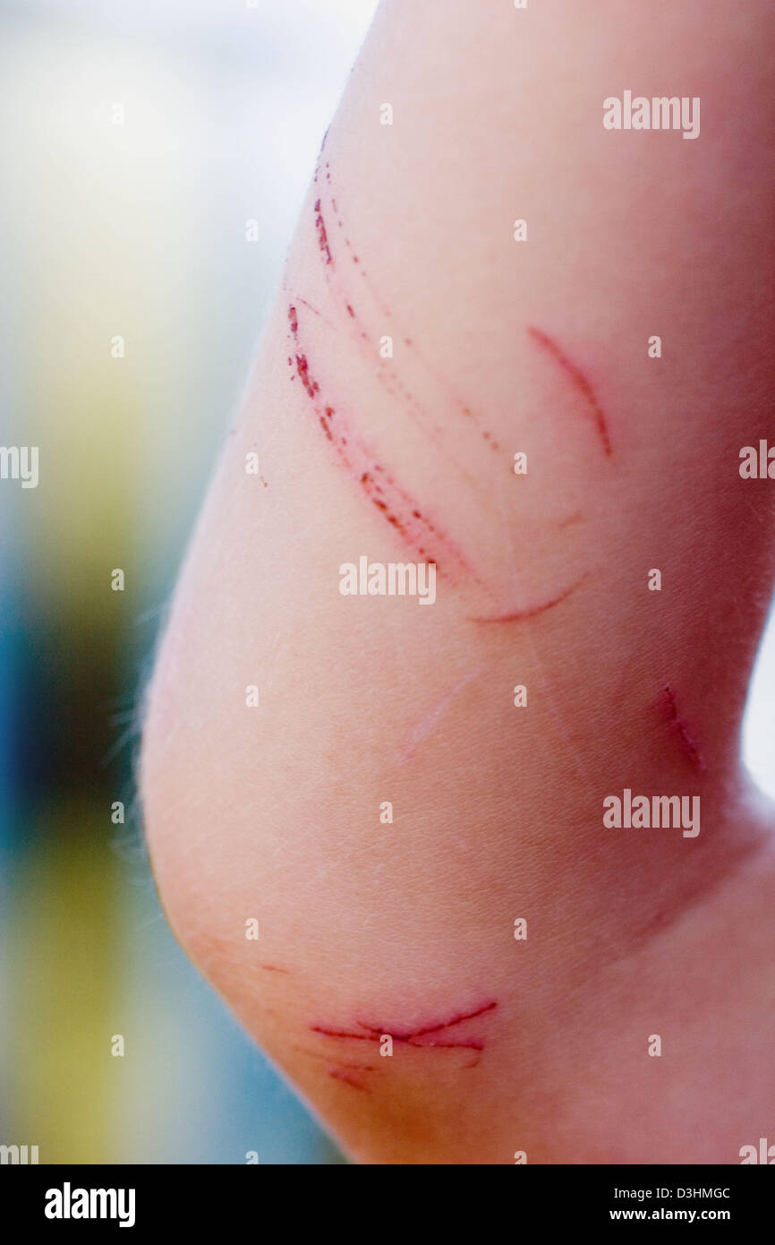 Injury thorn hi-res stock photography and images - Alamy