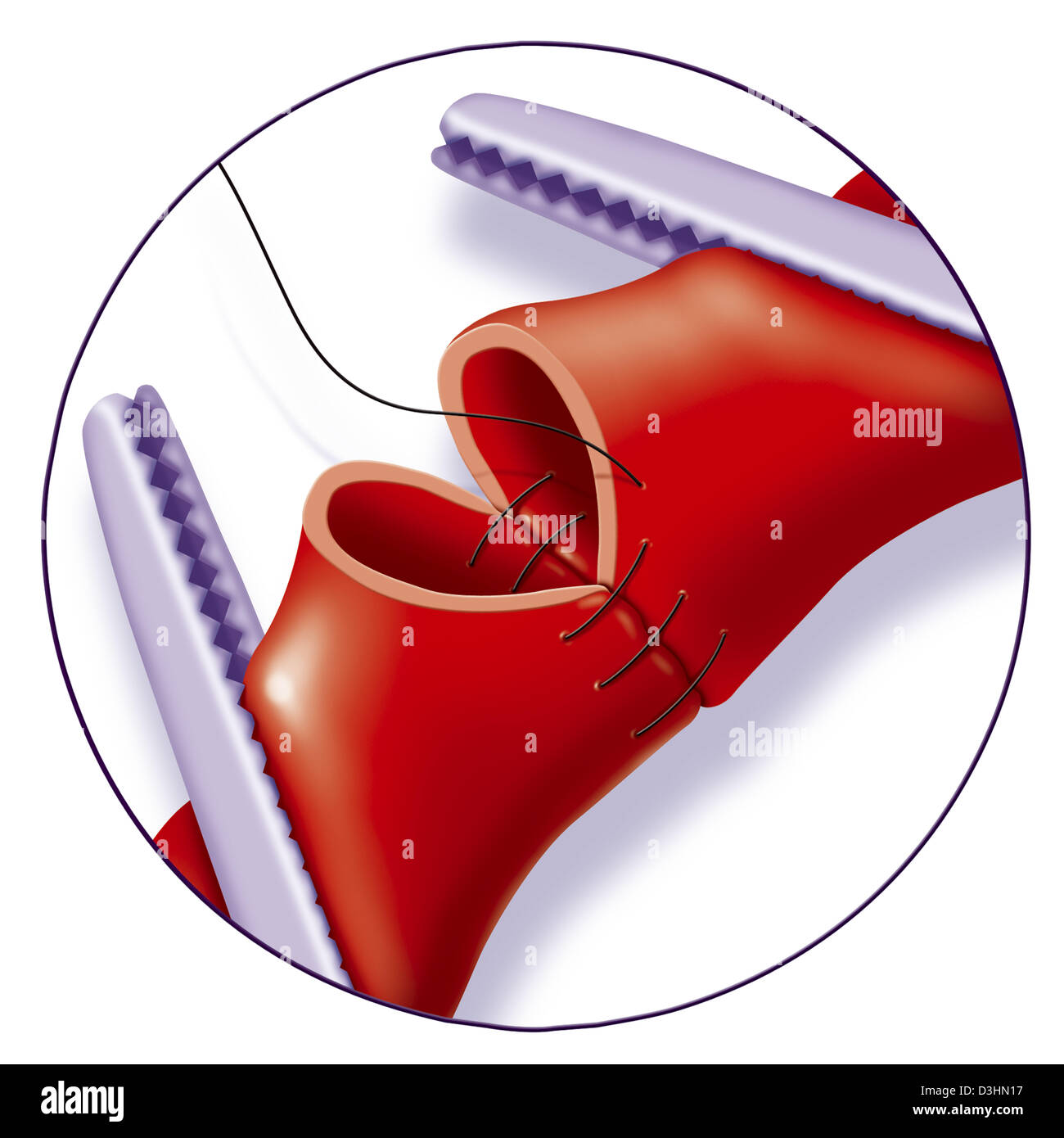Artery Clamp High Resolution Stock Photography and Images - Alamy