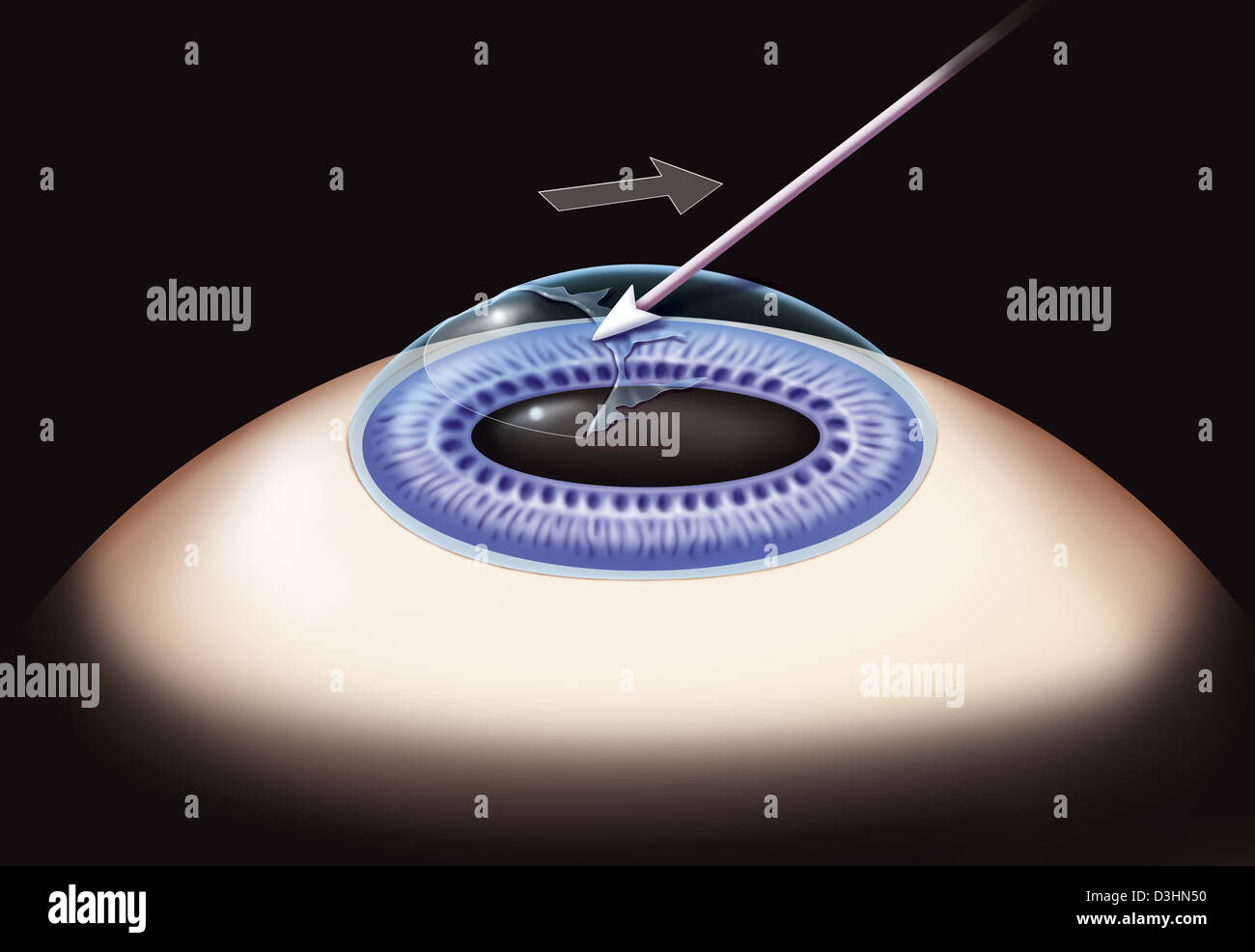 EYE SURGERY, DRAWING Stock Photo - Alamy