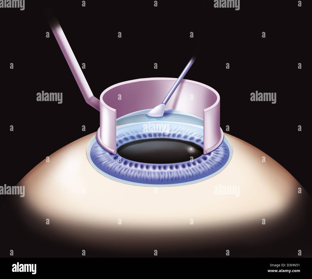 EYE SURGERY, DRAWING Stock Photo - Alamy