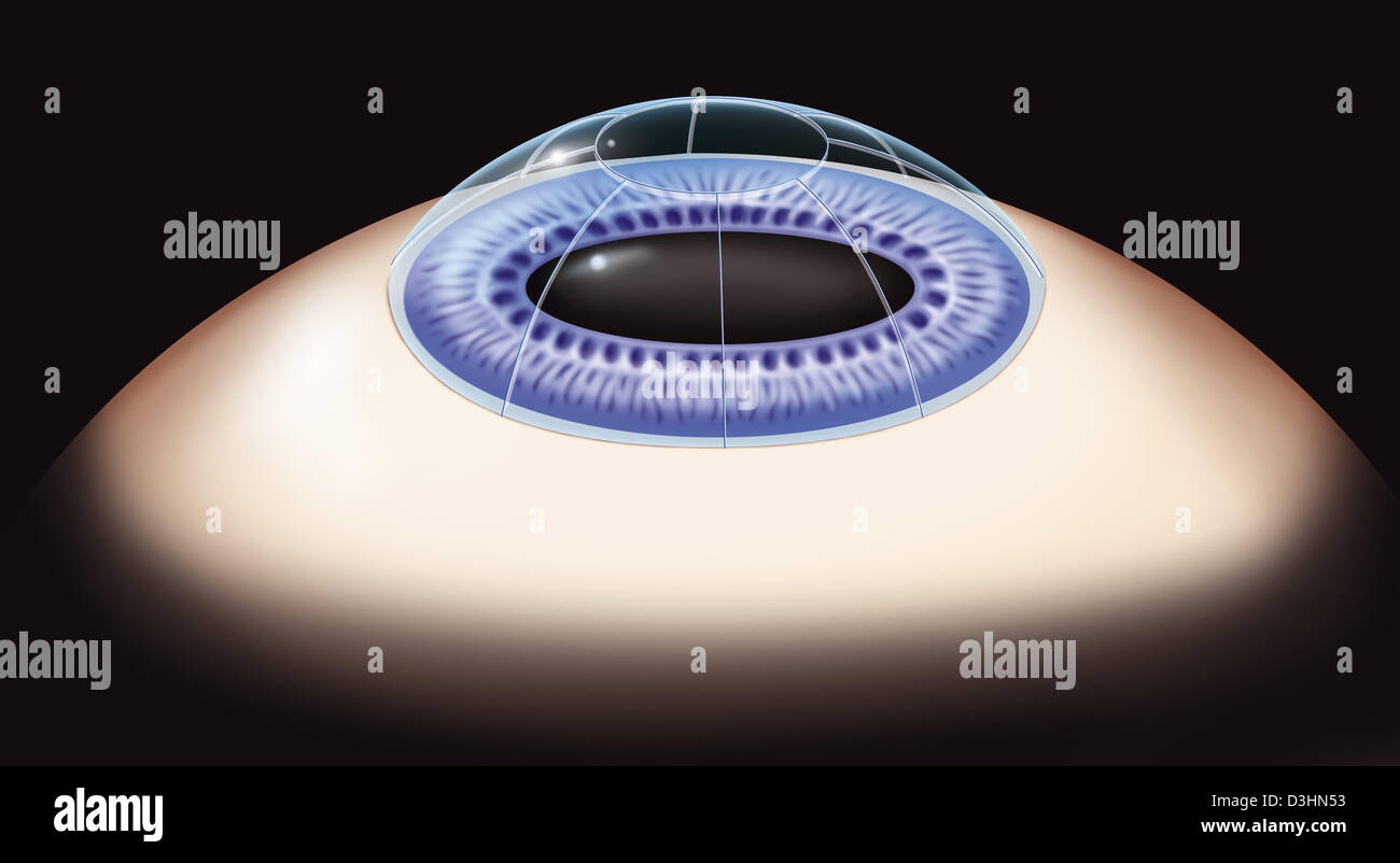 EYE SURGERY, DRAWING Stock Photo - Alamy