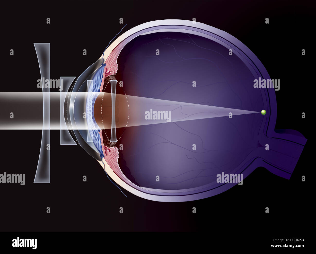 MYOPIA TREATMENT, ILLUSTRATION Stock Photo - Alamy