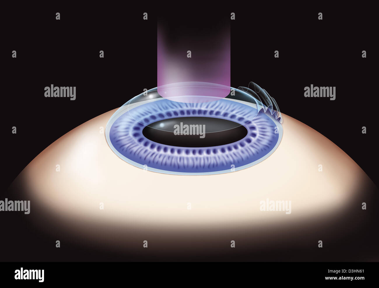Lasek laser eye surgery hi-res stock photography and images - Alamy