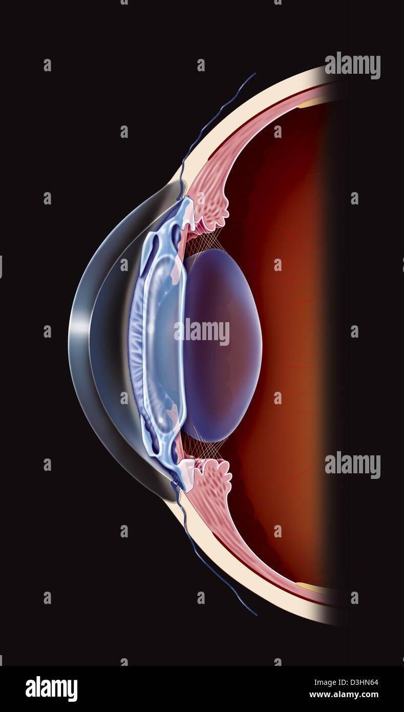 Posterior chamber intraocular lenses hi-res stock photography and ...