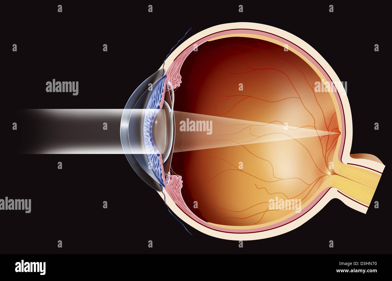 Posterior chamber intraocular lenses hi-res stock photography and ...