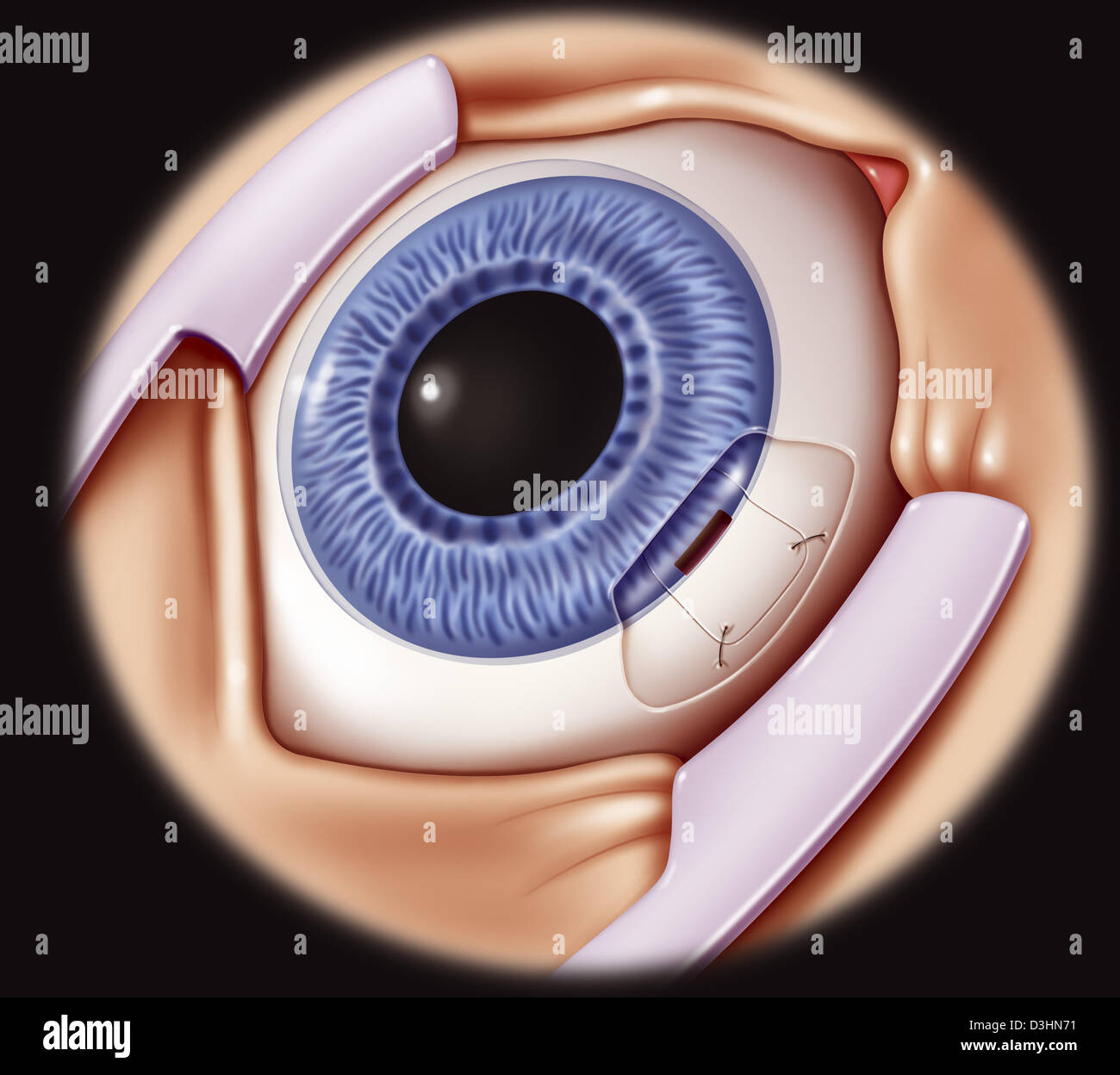 GLAUCOMA SURGERY, DRAWING Stock Photo - Alamy