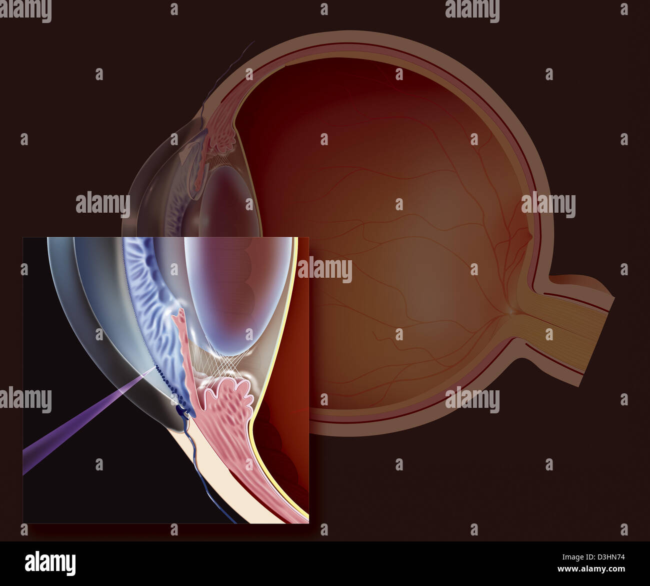 Glaucoma surgery hi-res stock photography and images - Alamy