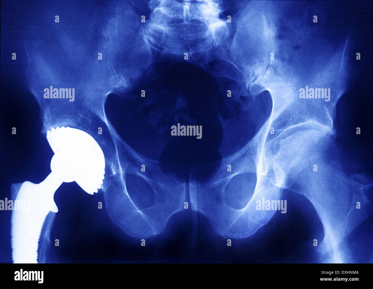 HIP PROSTHESIS, X-RAY Stock Photo - Alamy