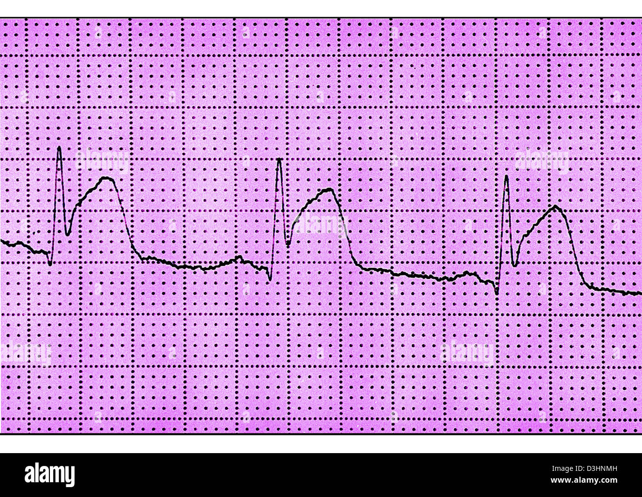 HEART ATTACK, ECG Stock Photo - Alamy