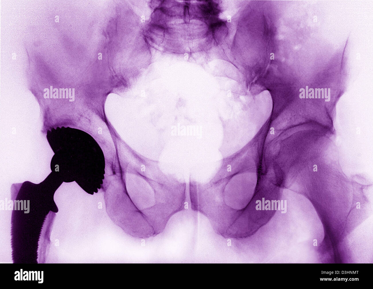 HIP PROSTHESIS, X-RAY Stock Photo - Alamy HIP PROSTHESIS, X-RAY Stock Photo - Alamy