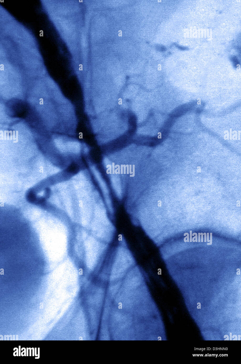 ARTERIAL STENOSIS, ANGIOGRAPHY Stock Photo - Alamy