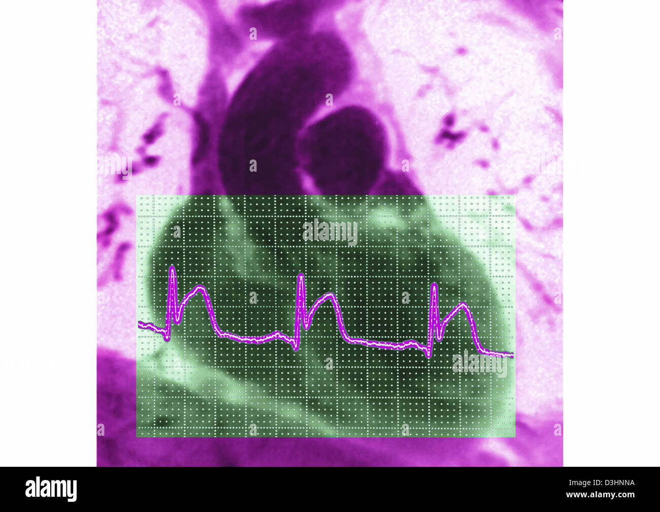Heart Attack Ecg Stock Photos & Heart Attack Ecg Stock Images - Alamy