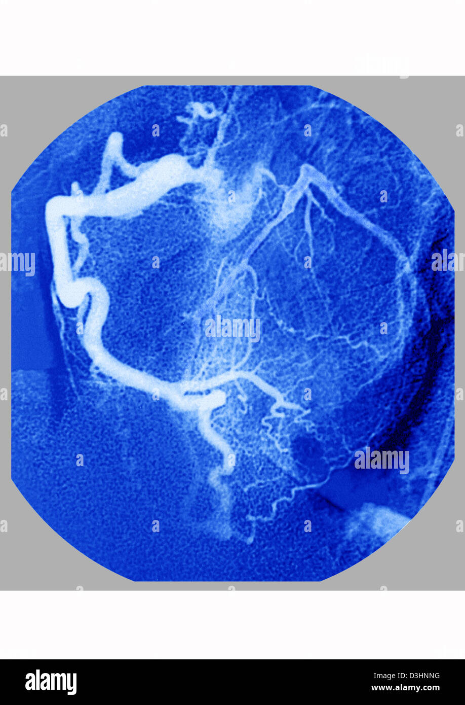 MYOCARDIAL INFARCTION, ANGIOGRA Stock Photo - Alamy