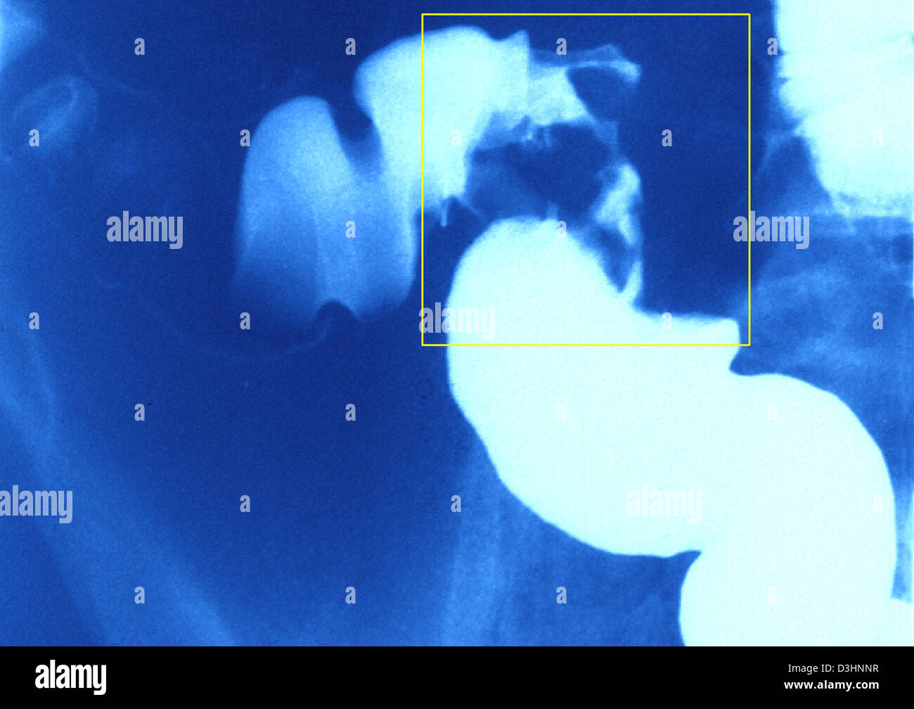 CANCER OF THE COLON, X-RAY Stock Photo - Alamy