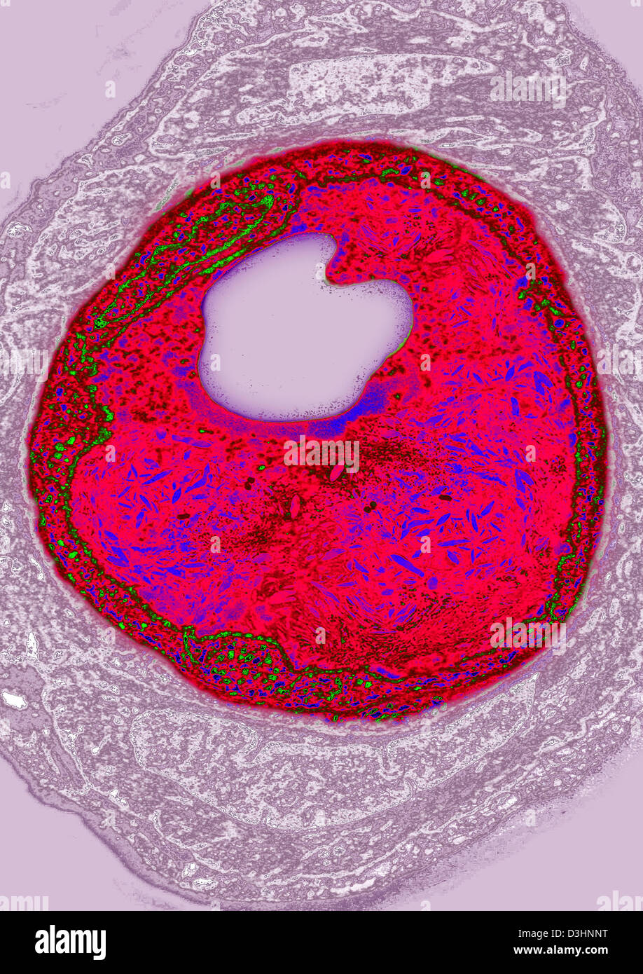 Atheroma histology hi-res stock photography and images - Alamy