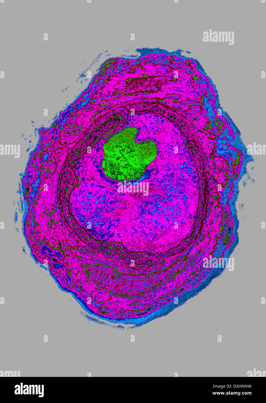 Atheroma histology hi-res stock photography and images - Alamy