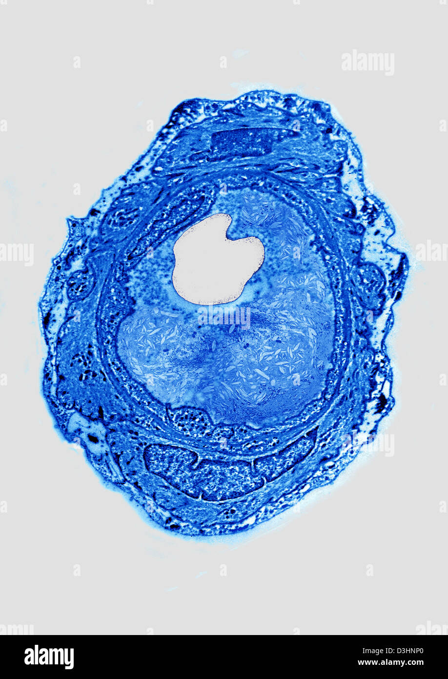 Atheroma histology hi-res stock photography and images - Alamy