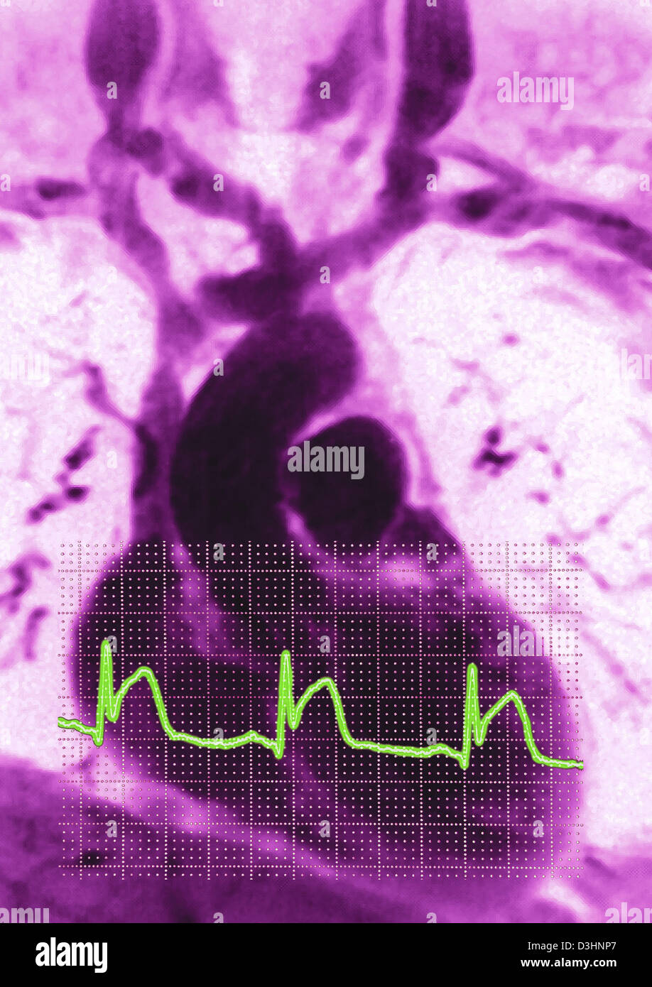HEART ATTACK, ECG Stock Photo - Alamy
