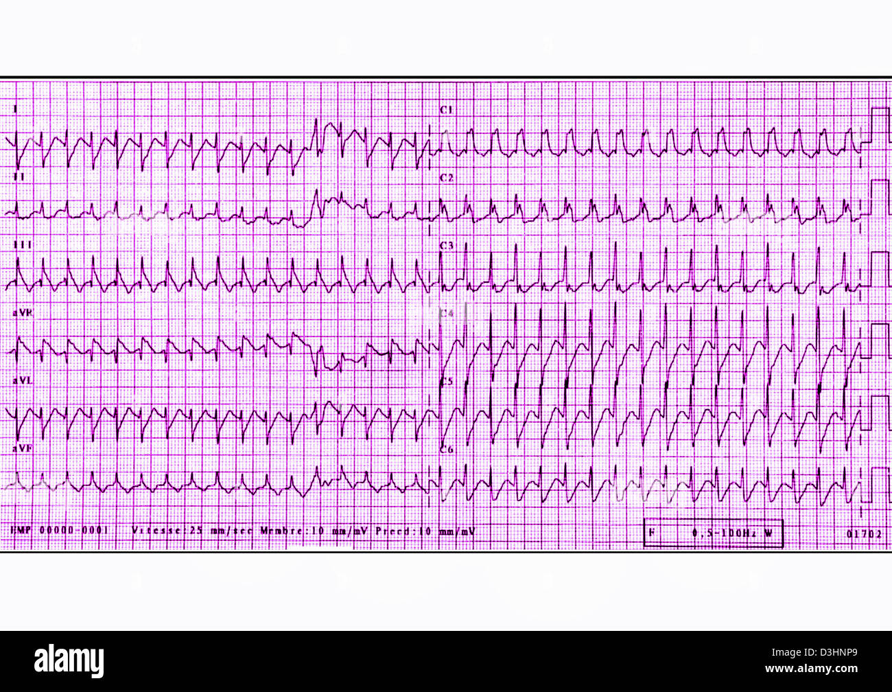 Tachycardia ecg hi-res stock photography and images - Alamy