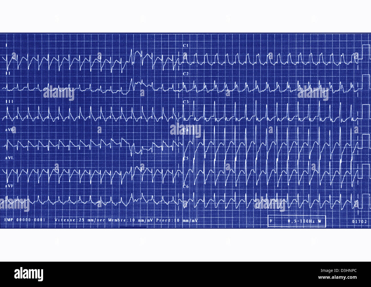 Paroxysmal Atrial Tachycardia Ecg