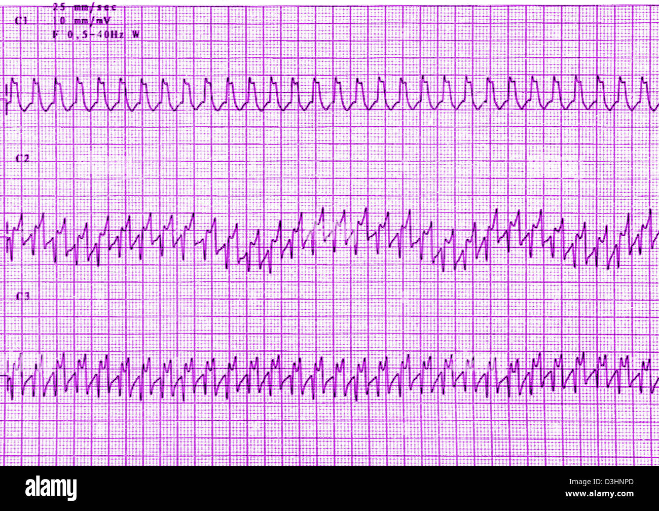 Flutter ecg hi-res stock photography and images - Alamy