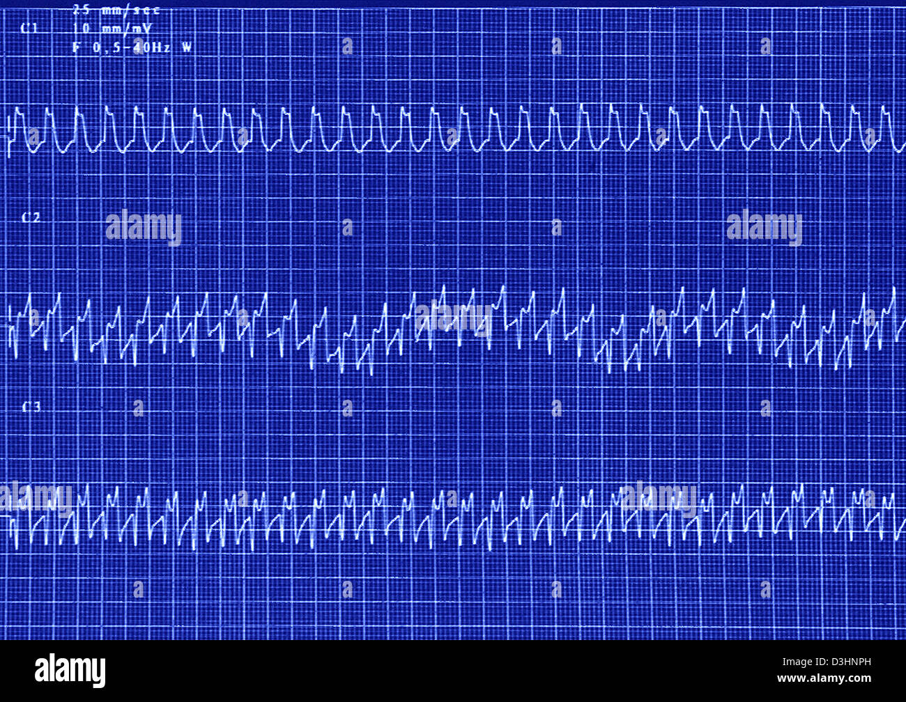 Flutter ecg hi-res stock photography and images - Alamy