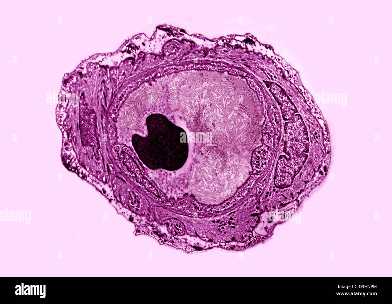 Atheroma High Resolution Stock Photography and Images - Alamy