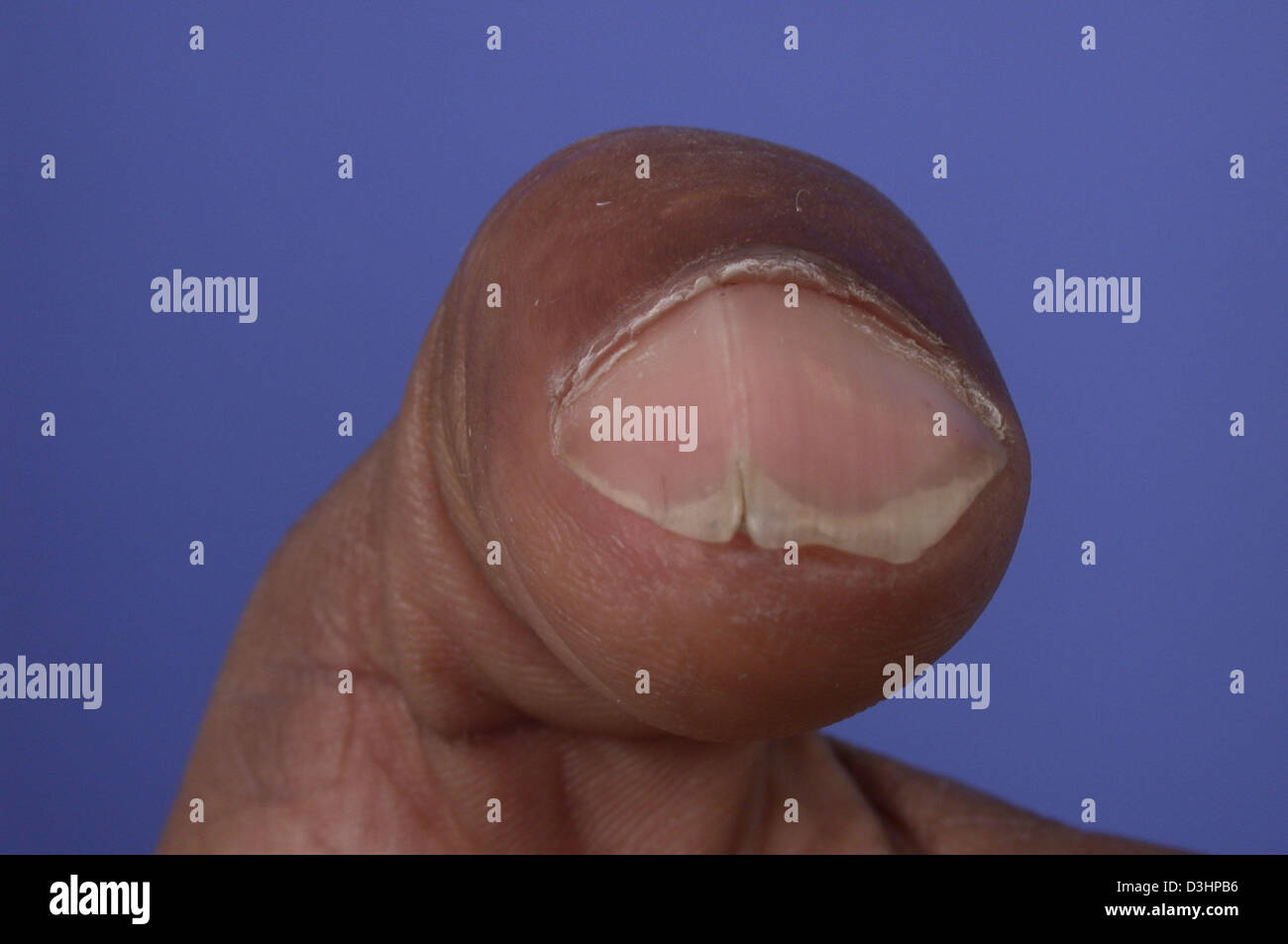 Bifid hi-res stock photography and images - Alamy