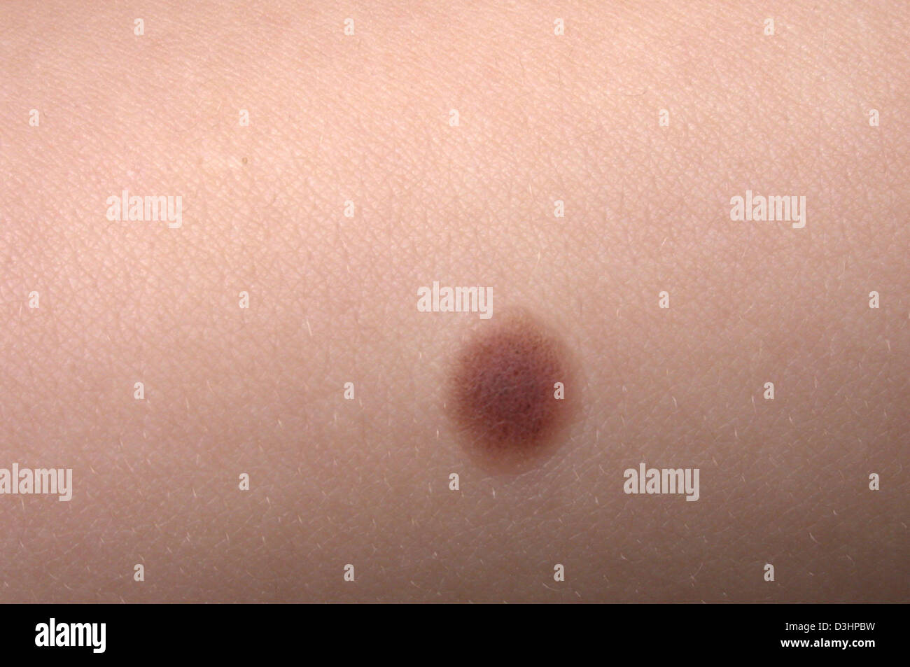 Spitz naevus hi-res stock photography and images - Alamy