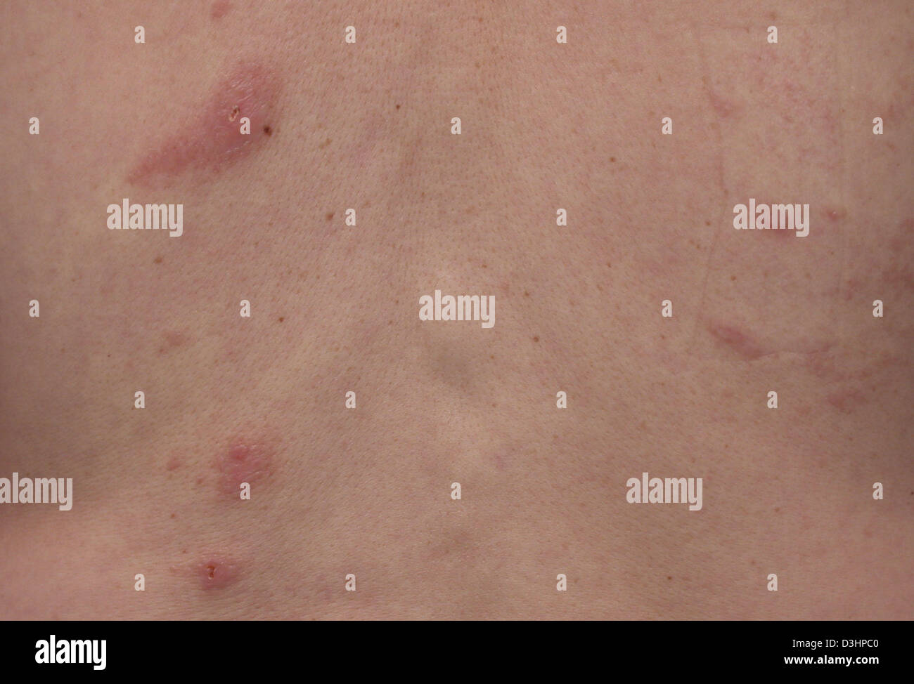 Jellyfish sting skin hi-res stock photography and images - Alamy