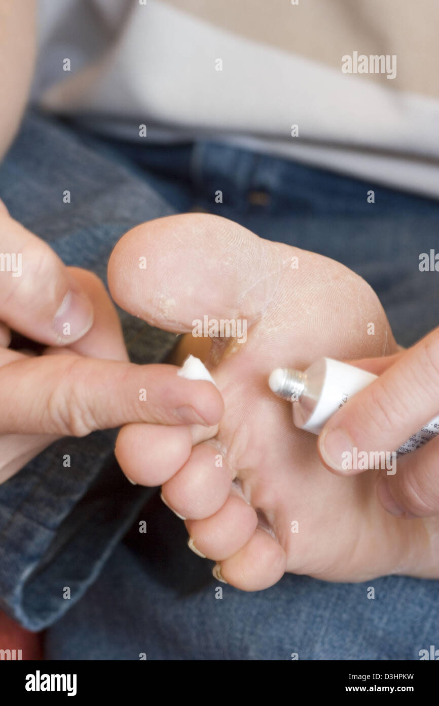 MYCOSIS ON A FOOT Stock Photo - Alamy