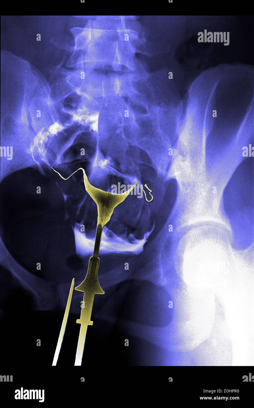 Hysterography hi-res stock photography and images - Alamy