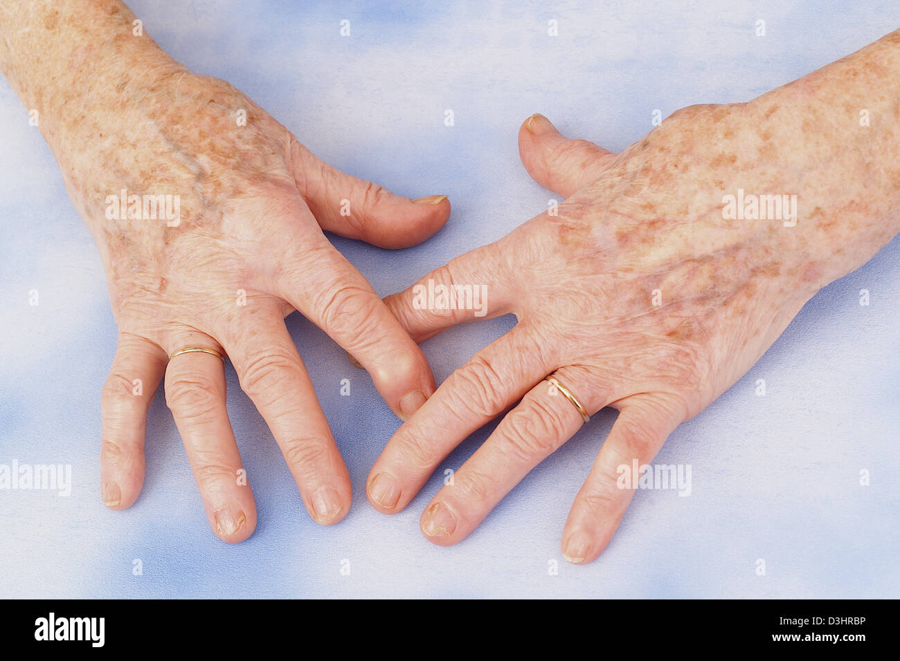 Osteoarthritis Hand High Resolution Stock Photography and Images - Alamy