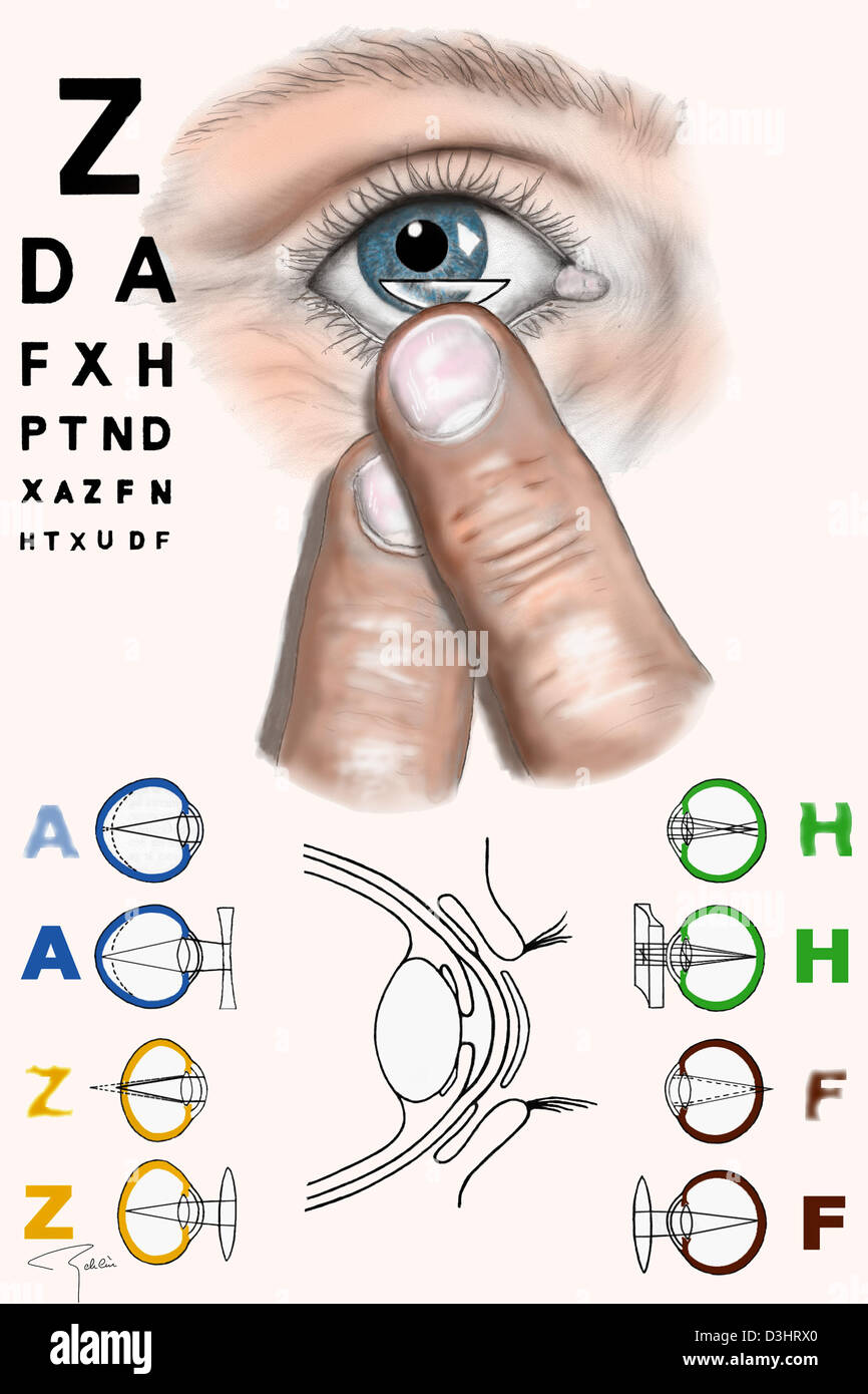 Astigmatic lens hi-res stock photography and images - Alamy