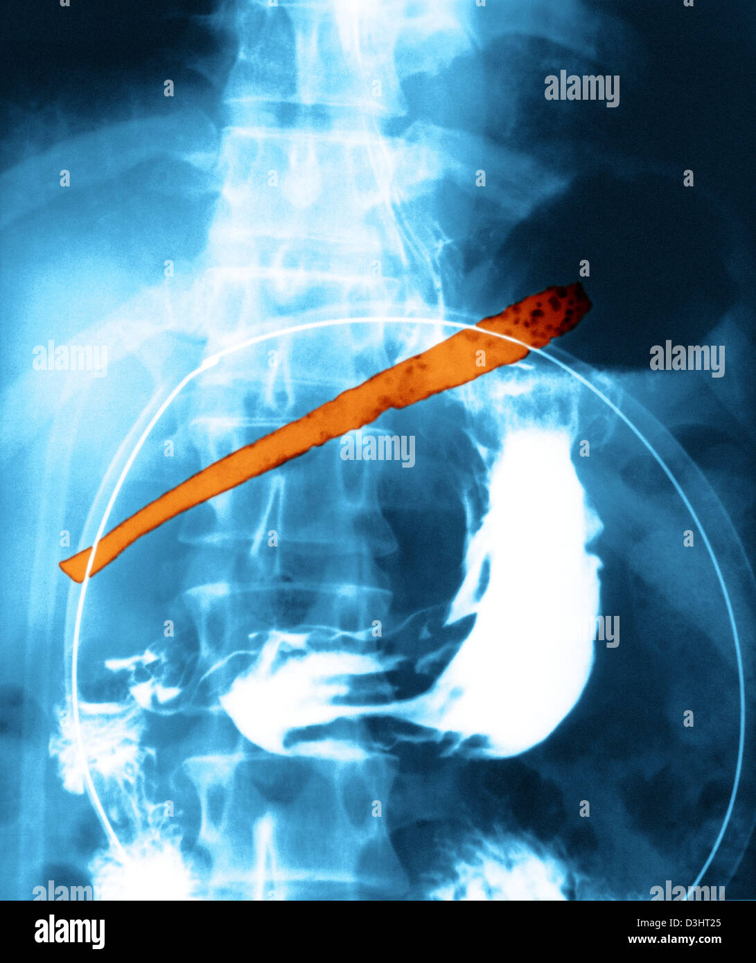 FOREIGN BODY IN STOMACH Stock Photo - Alamy