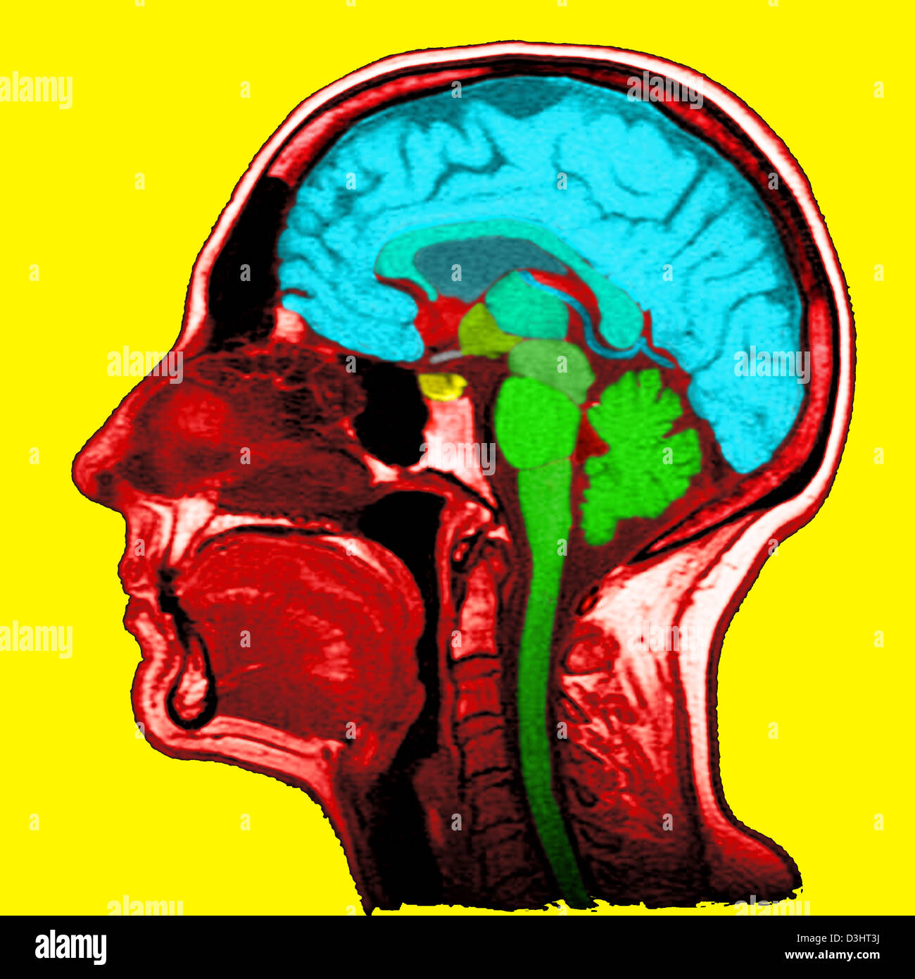 Corpus callosum mri hi-res stock photography and images - Alamy