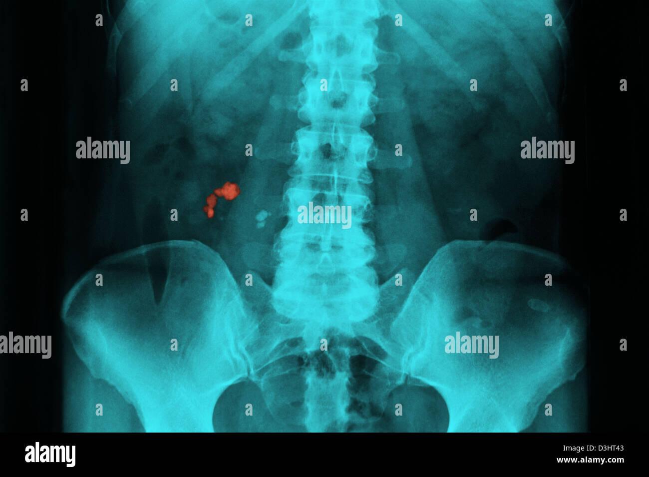 Lithiasis hi-res stock photography and images - Alamy