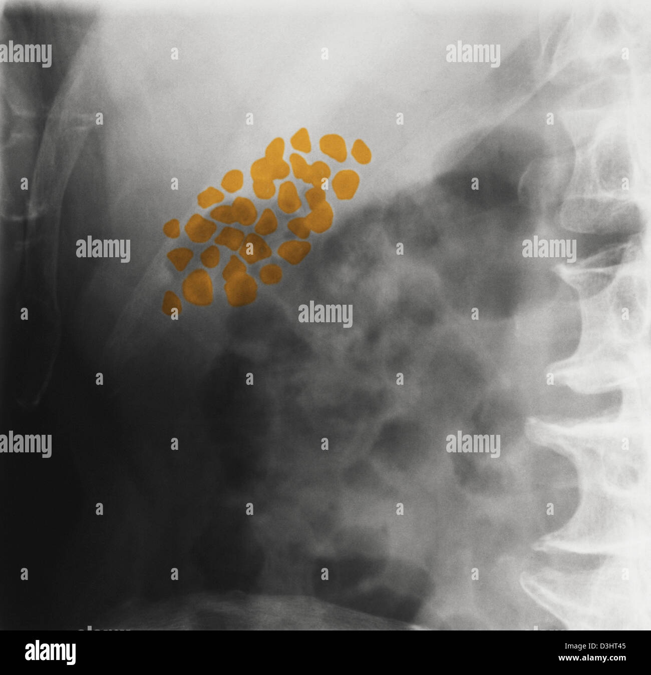 GALLSTONE, X-RAY Stock Photo - Alamy