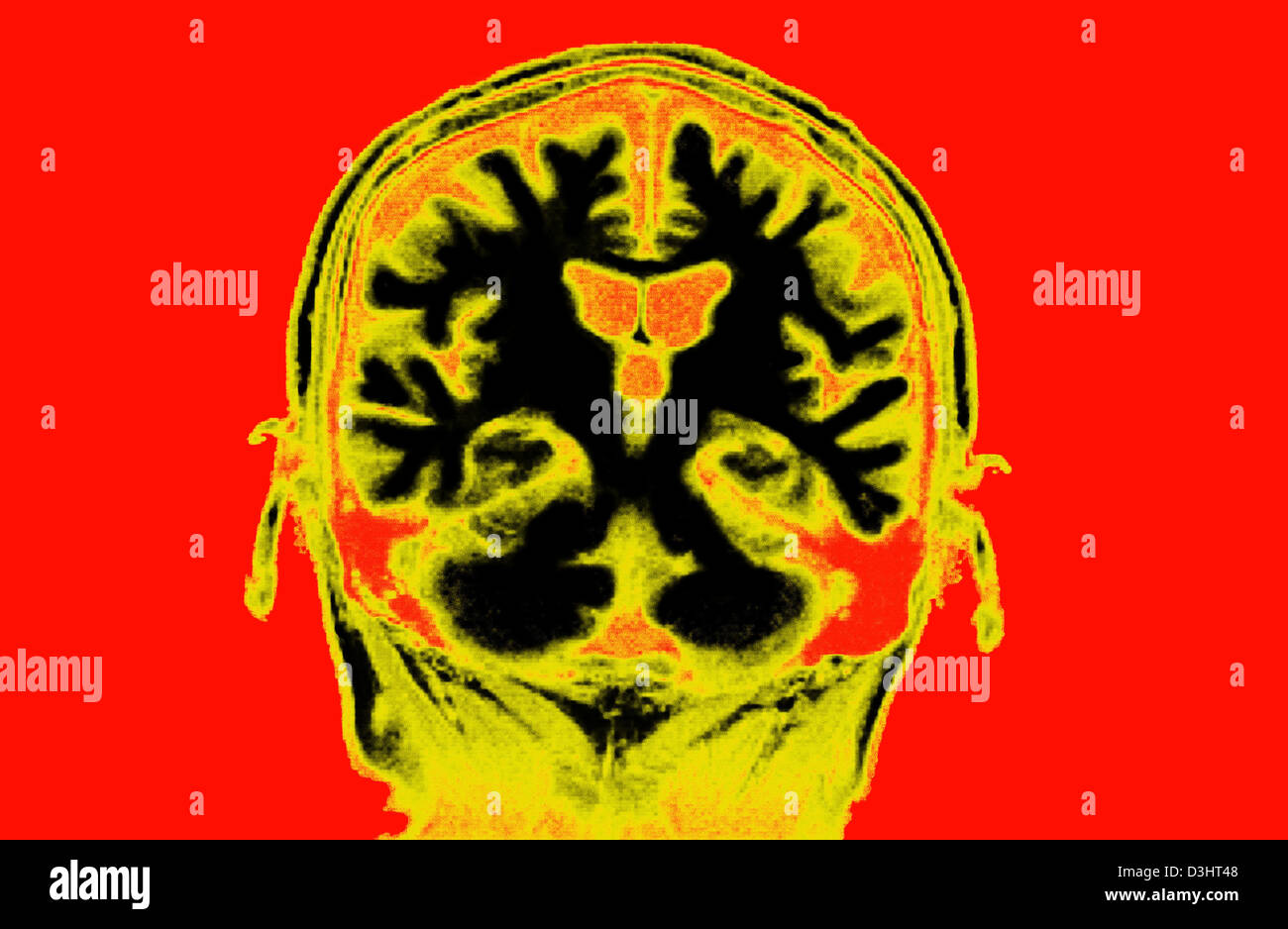 Normal brain mri hi-res stock photography and images - Alamy