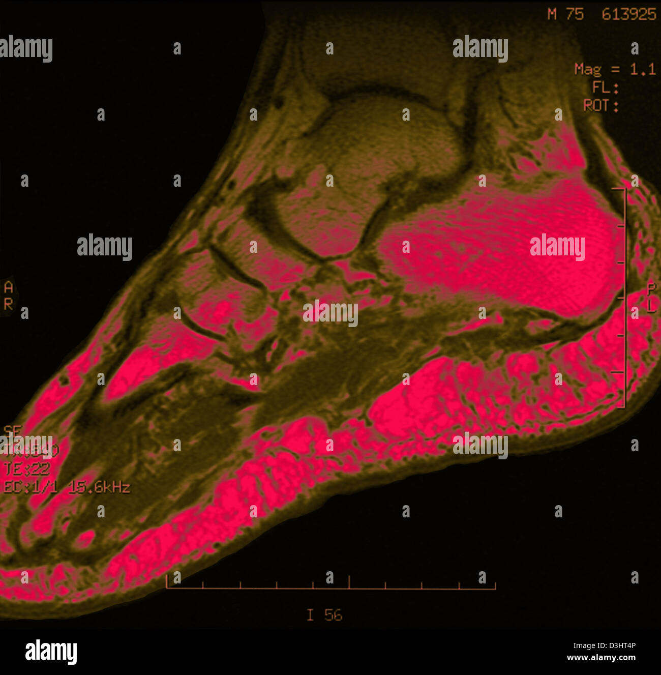 Foot mri scan hi-res stock photography and images - Alamy