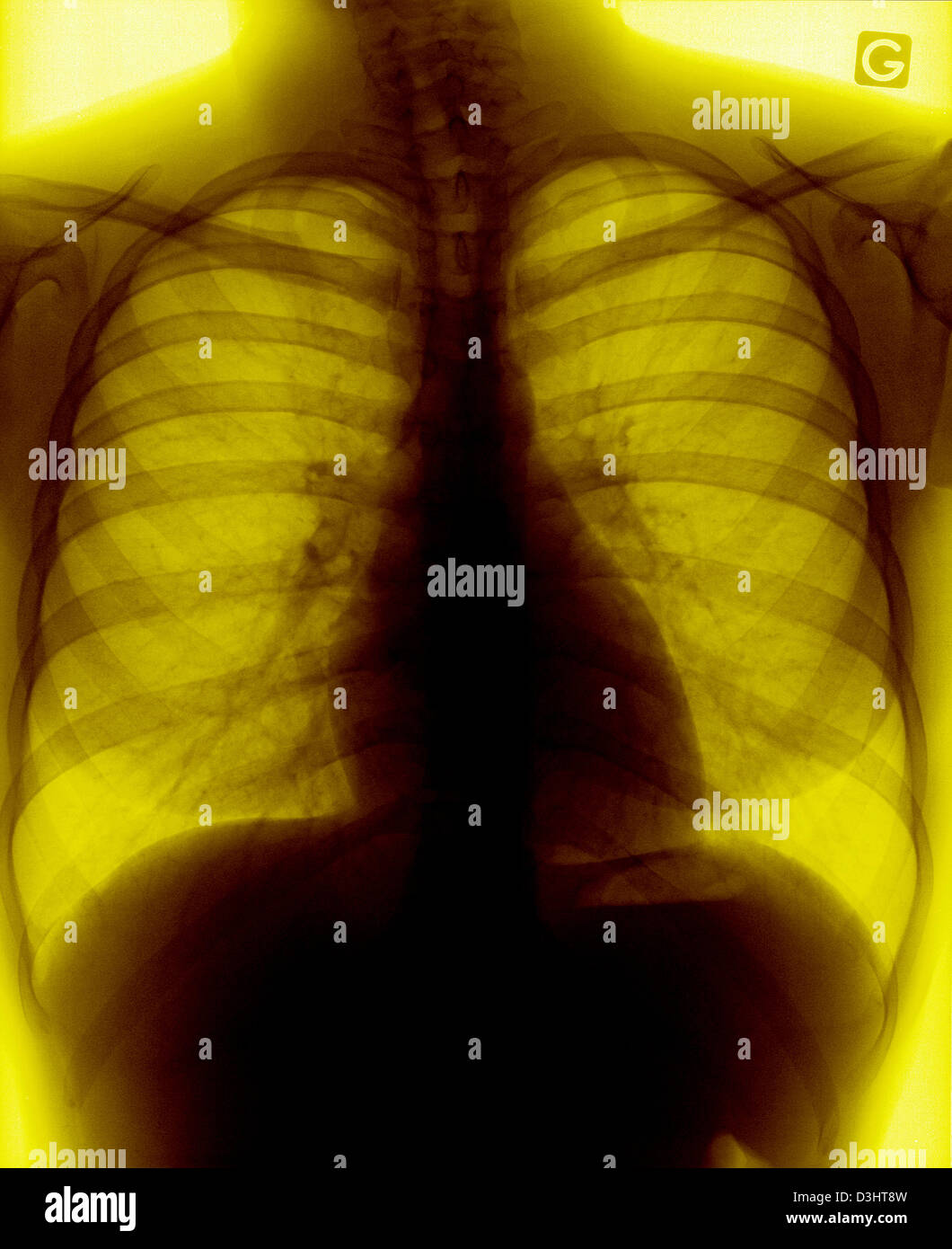 Healthy Lungs X Ray Stock Photos & Healthy Lungs X Ray Stock Images - Alamy