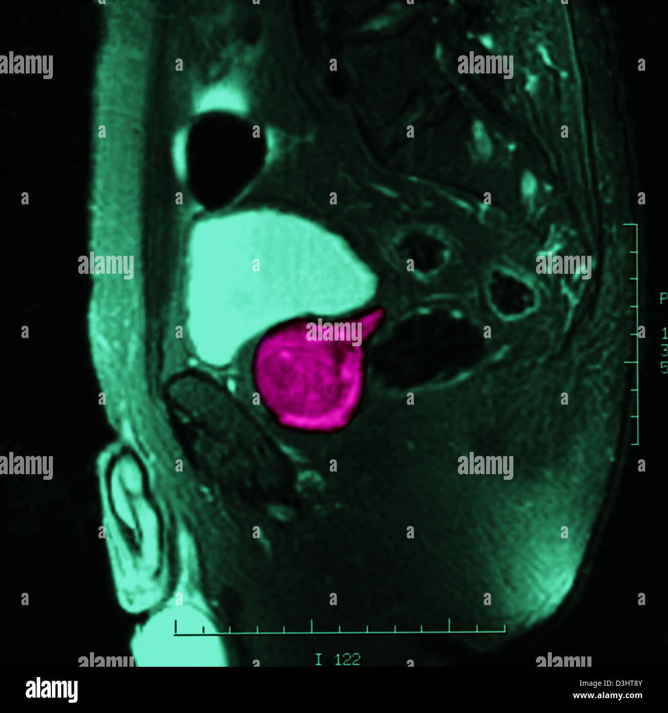PROSTATIC ADENOMA, MRI Stock Photo - Alamy