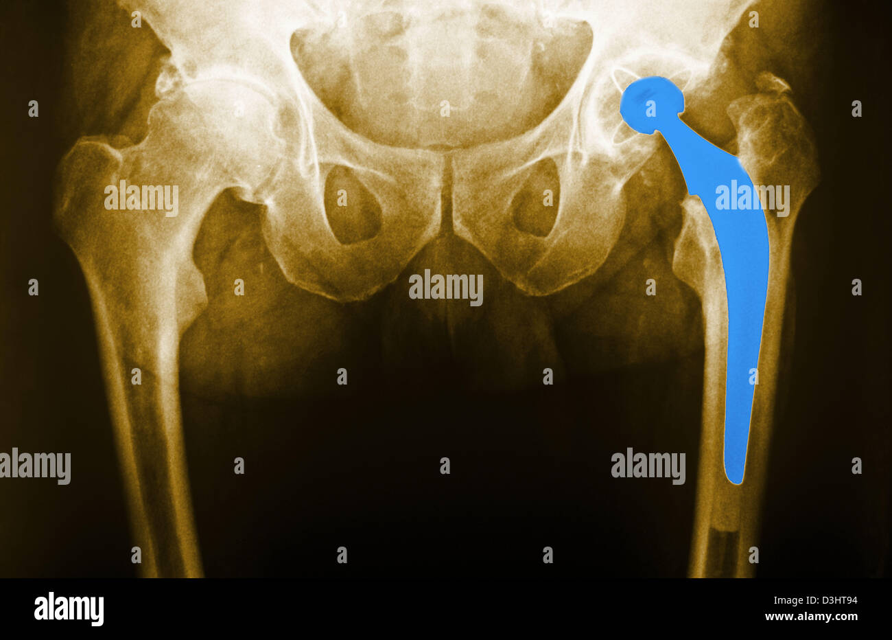 HIP PROSTHESIS, X-RAY Stock Photo - Alamy HIP PROSTHESIS, X-RAY Stock Photo - Alamy