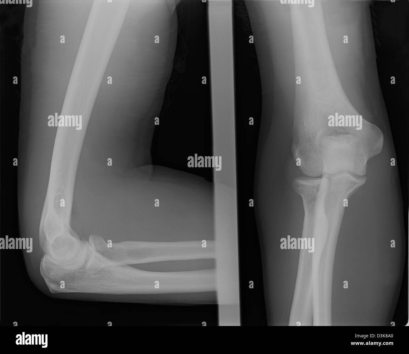 two X-ray images of broken human elbow Stock Photo - Alamy