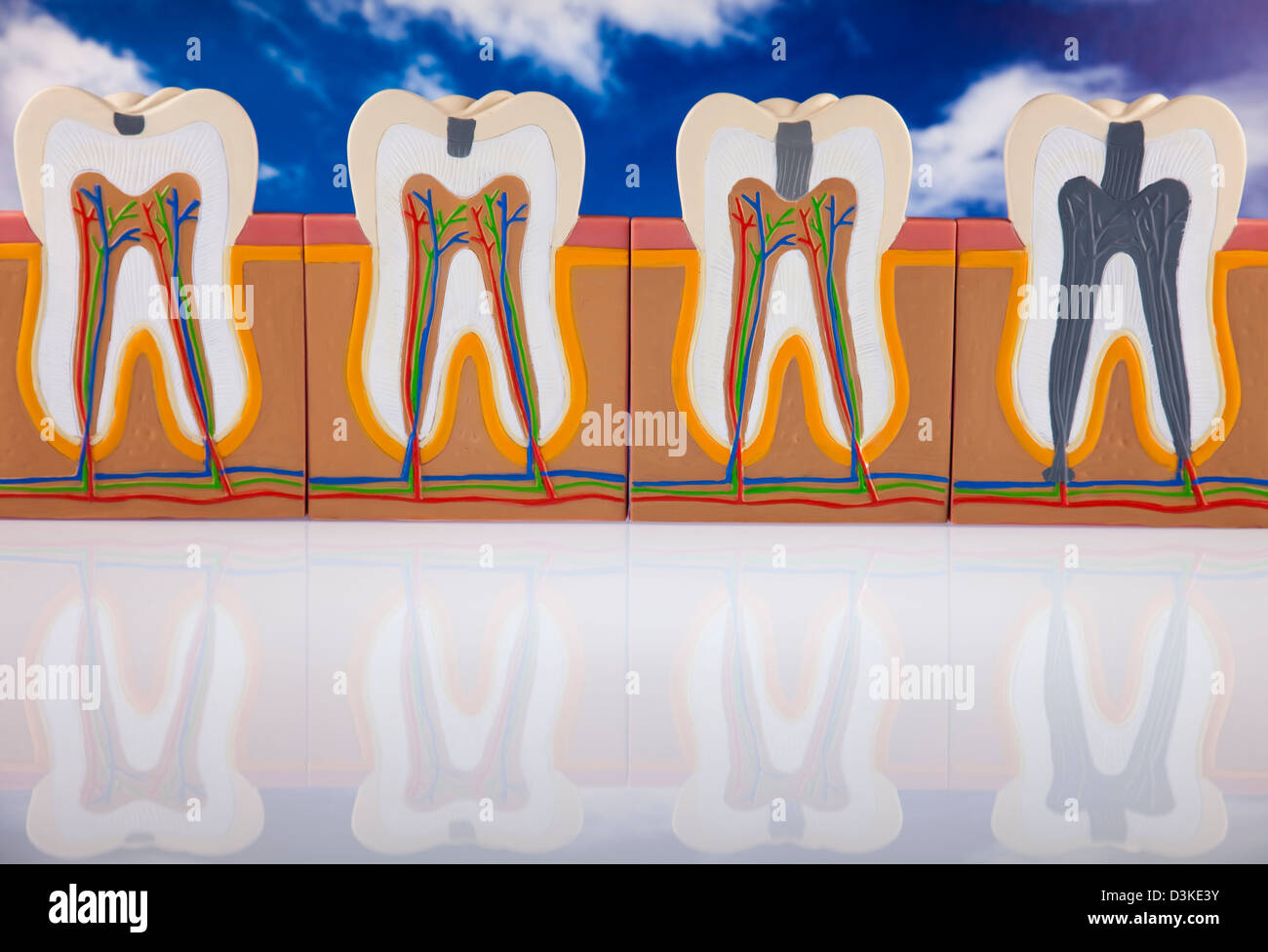 Human tooth structure with caries Stock Photo - Alamy