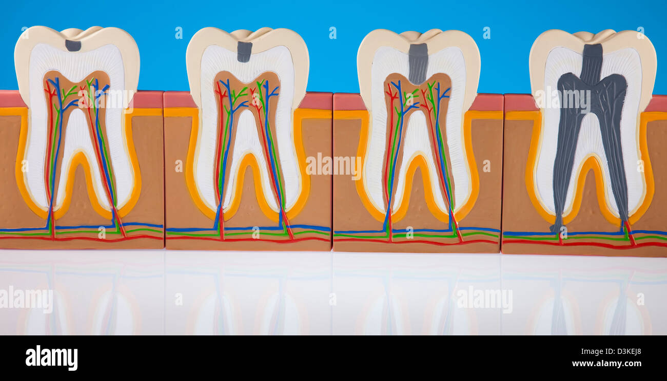 Anatomy of the teeth with caries Stock Photo - Alamy