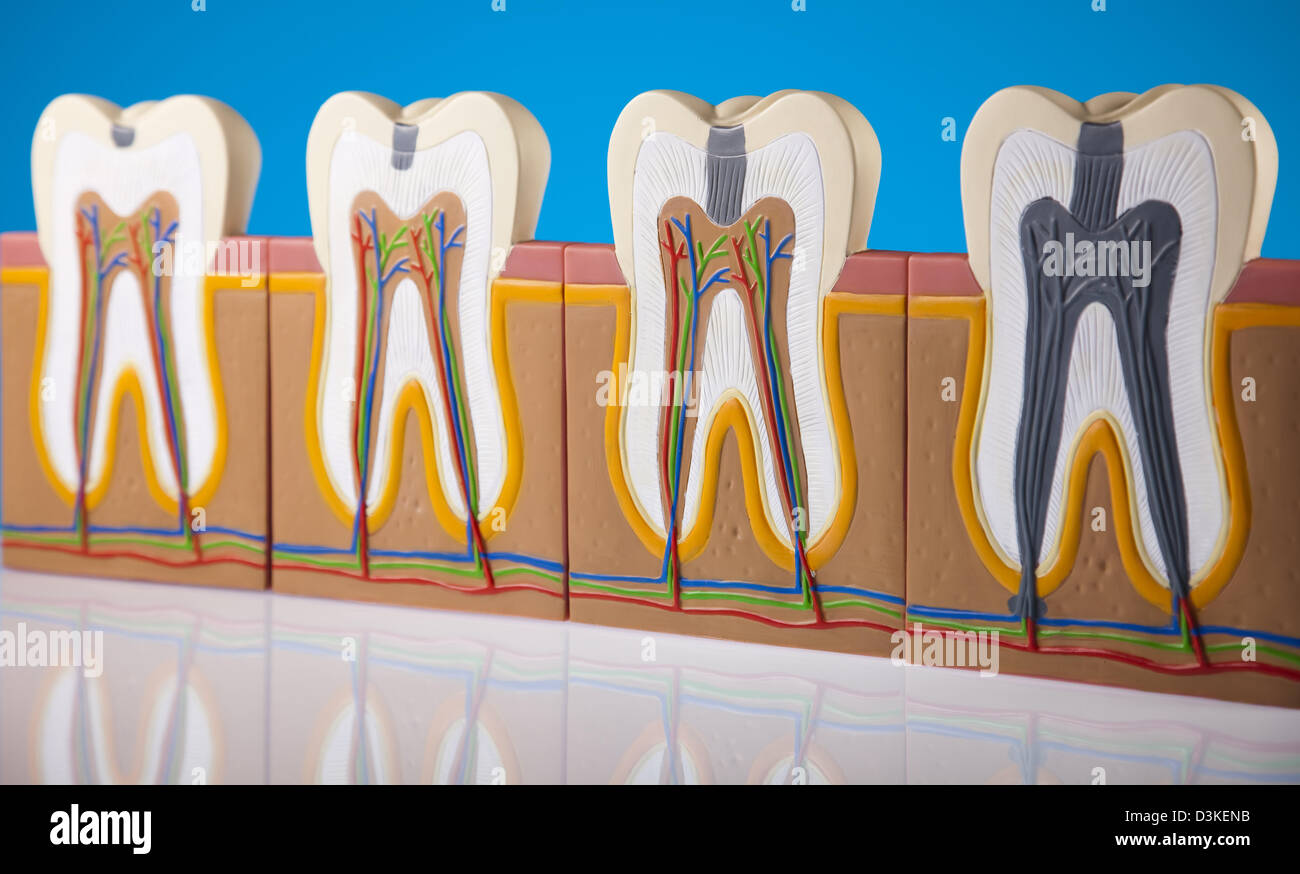 Anatomy of the teeth with caries Stock Photo - Alamy